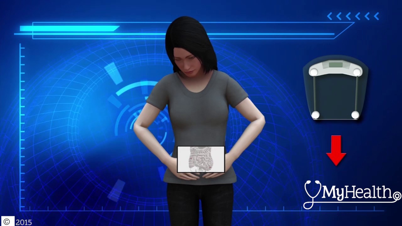 Colorectal Cancer Animation - YouTube