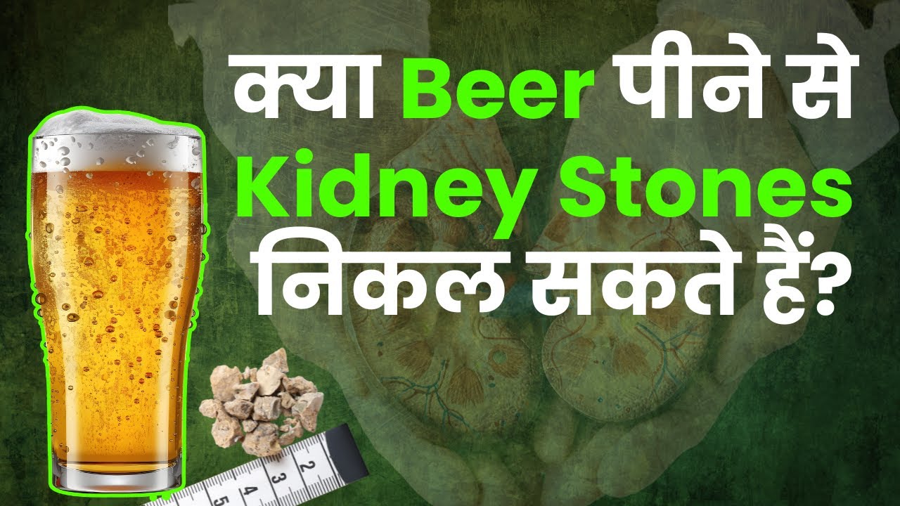Does Drinking Beer Help in Passing Kidney Stones? | क्या बीयर पीने से ...