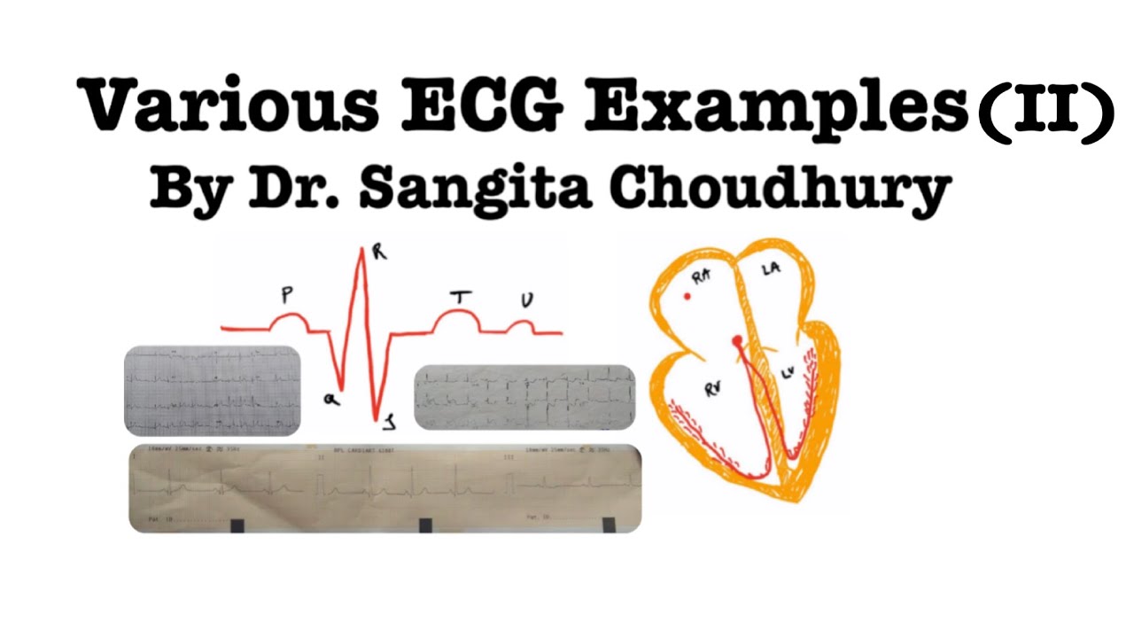 Interpretation from real ECG (II) #ecgproblems #diagnosisfromecg # ...