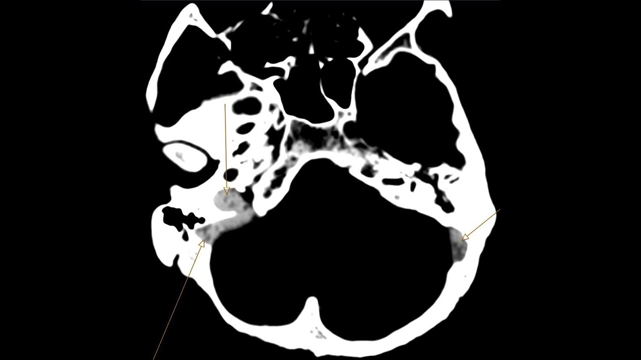 Venus Sinus Thrombosis and Intraventricular haemorrhage - CT, CT ...