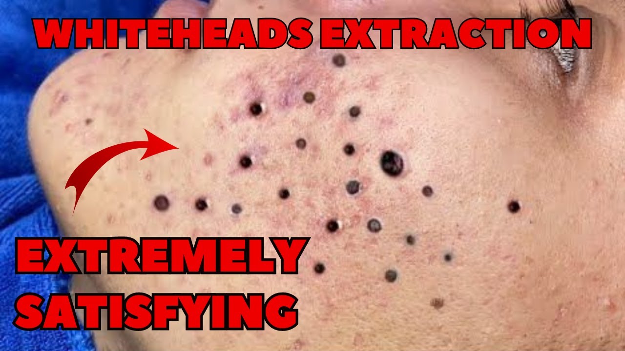 Satisfying Whiteheads EXTRACTION | Pimple Popping Relaxation - YouTube