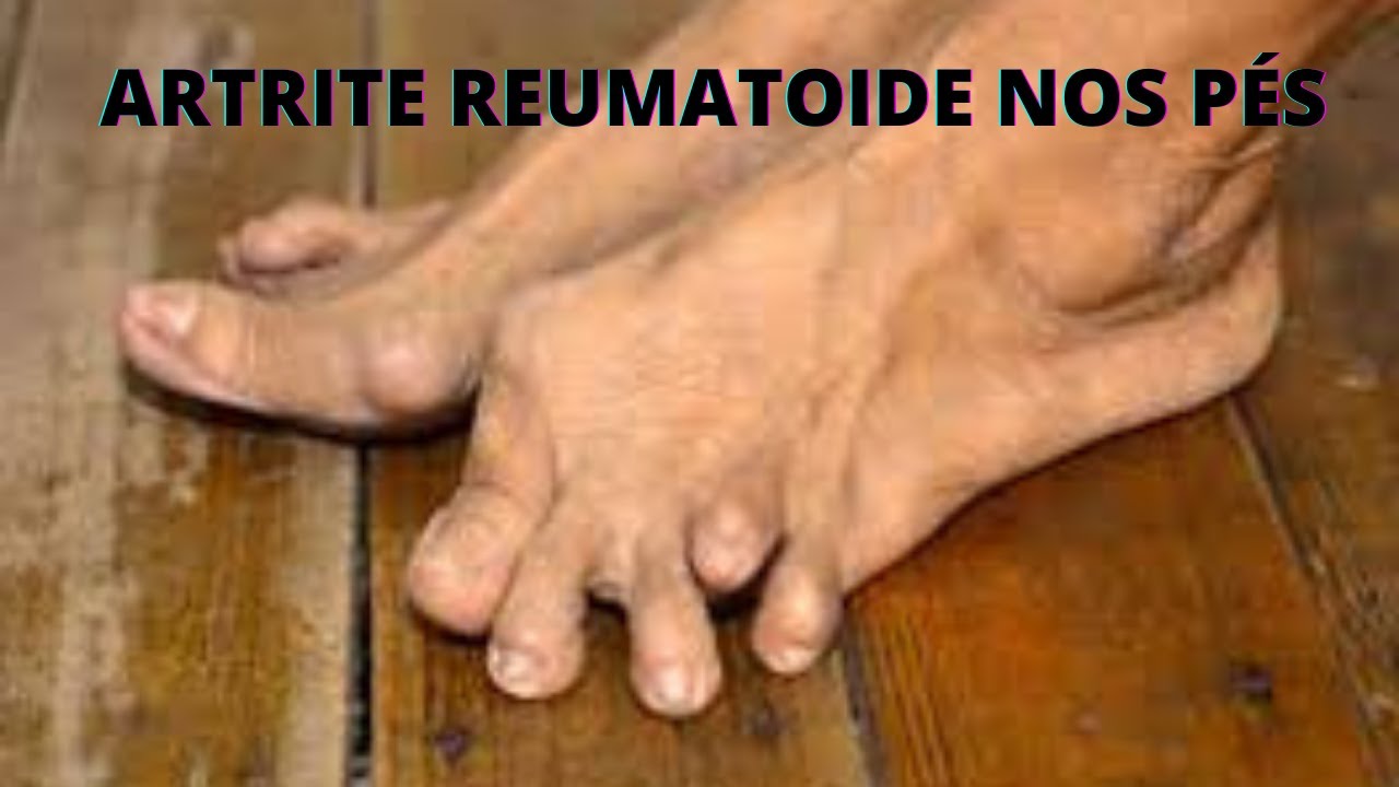ARTRITE REUMATOIDE NOS PÉS - YouTube
