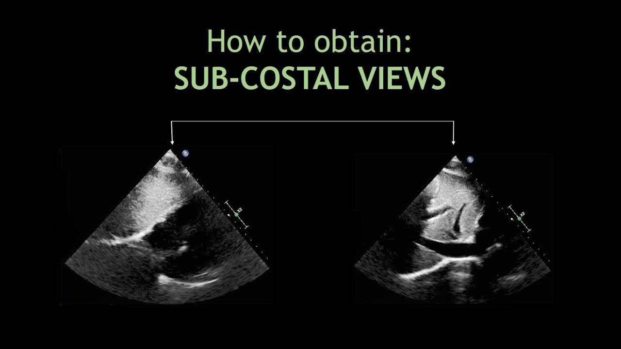 How to obtain: SUB-COSTAL VIEWS! (Echocardiography) - YouTube