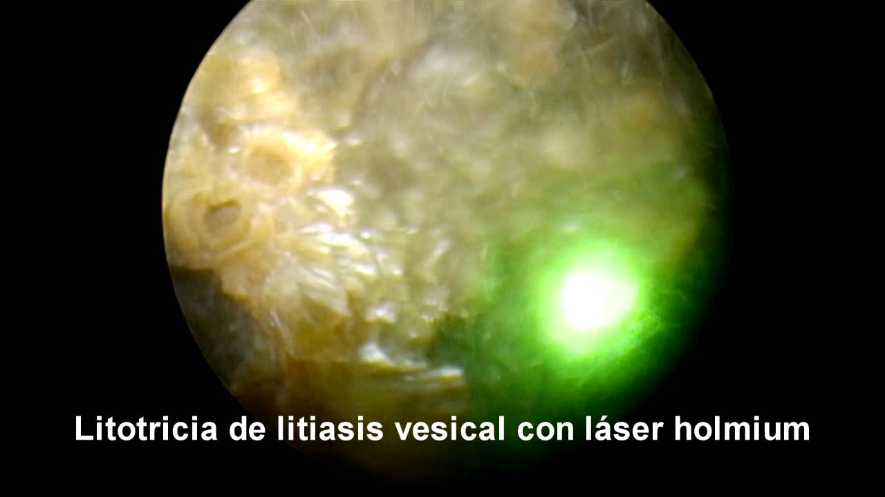 Litotricia litiasis vesical laser holmium. Holmium laser lithotripsy in ...