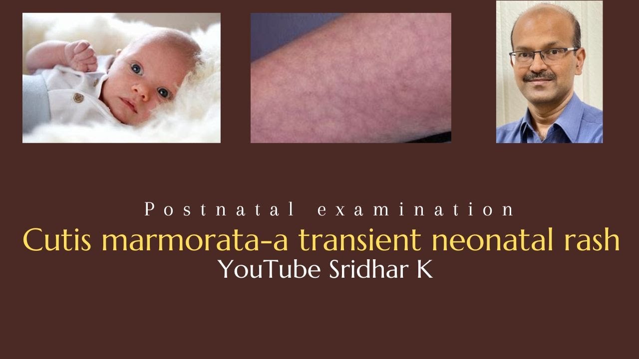 Cutis marmorata a transient neonatal rash. Dr Sridhar K - YouTube