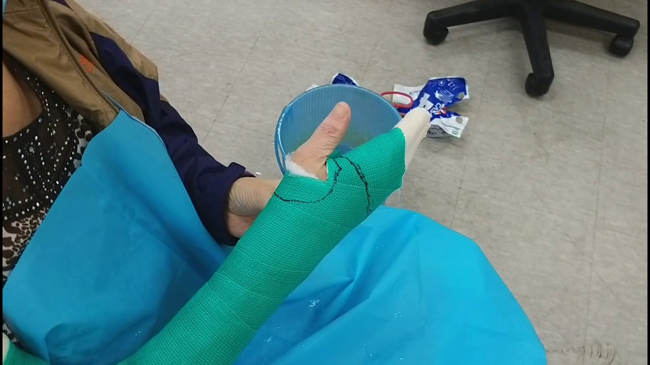 Long arm cast - YouTube