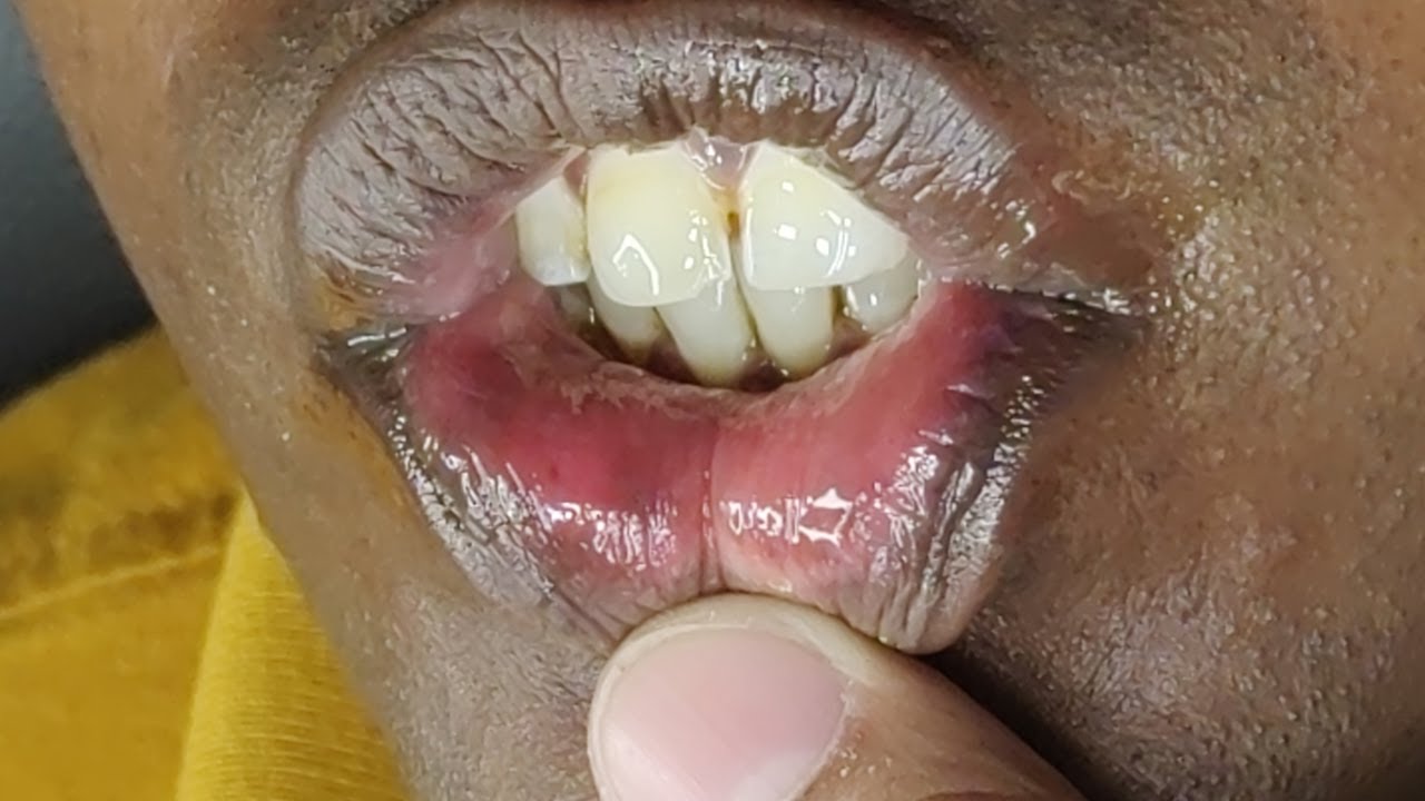 Lip Vitiligo Skin Colour Tattoo, Vitiligo or Leucoderma Treatment ...