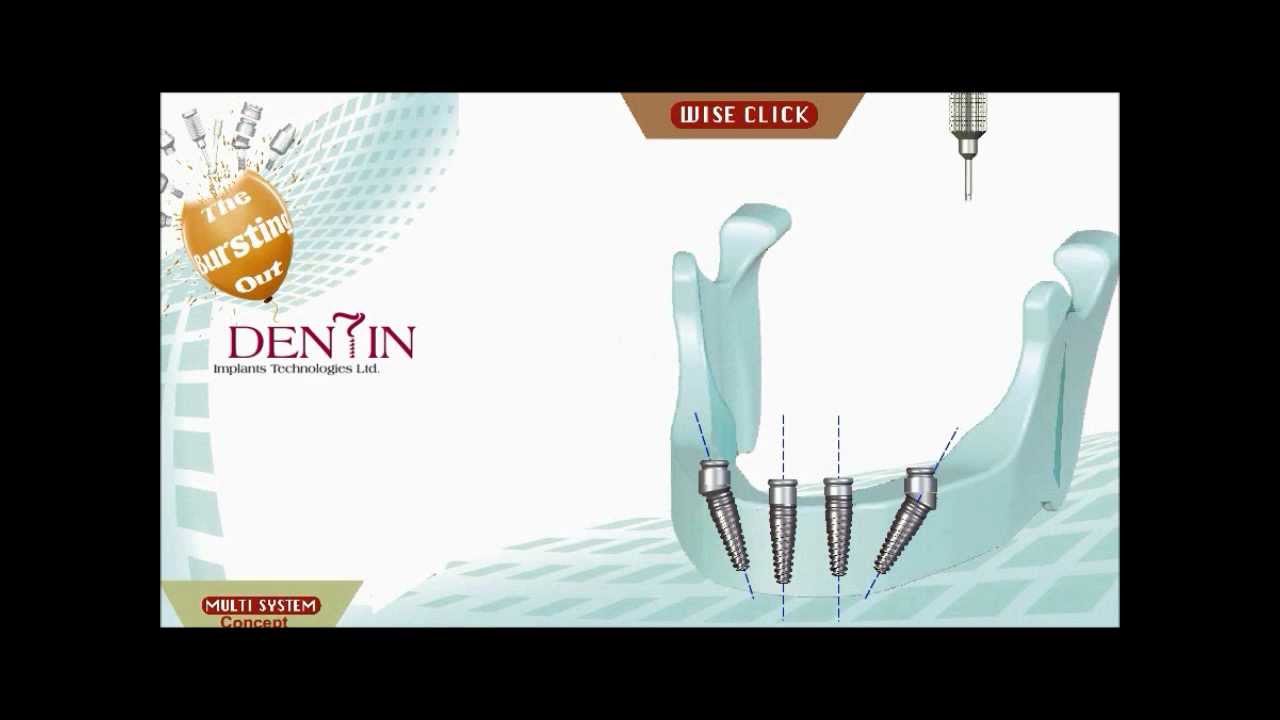 Dental Multi System DENTIN Implants Technologies Ltd - YouTube