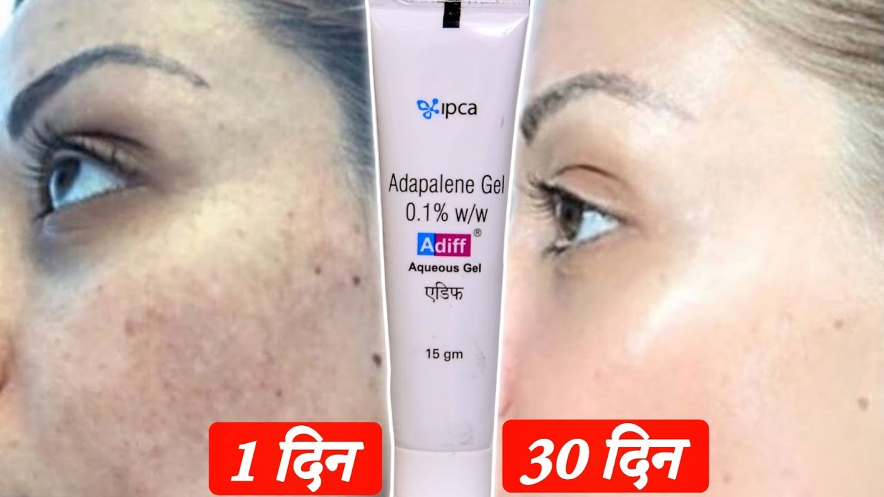 Adiff Gel 🔥| रातों रात काले दाग धब्बे और दाने साफ हो जायेंगे | Uses ...