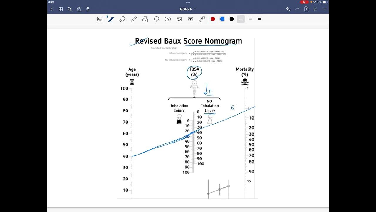 Revised Baux Scoring system | Burns Management - YouTube