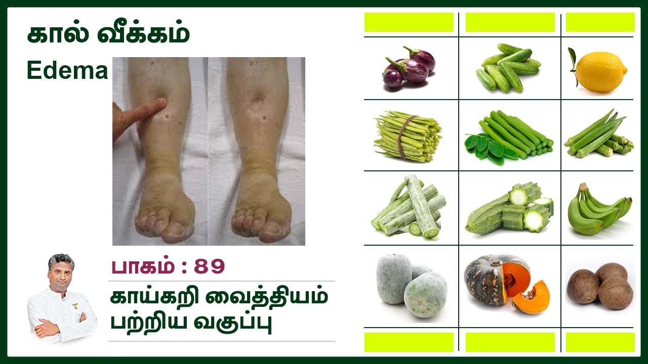 பாகம் 89 | கால் வீக்கம் | Edema | காய்கறி வகுப்பு | Vegetable Clinic ...