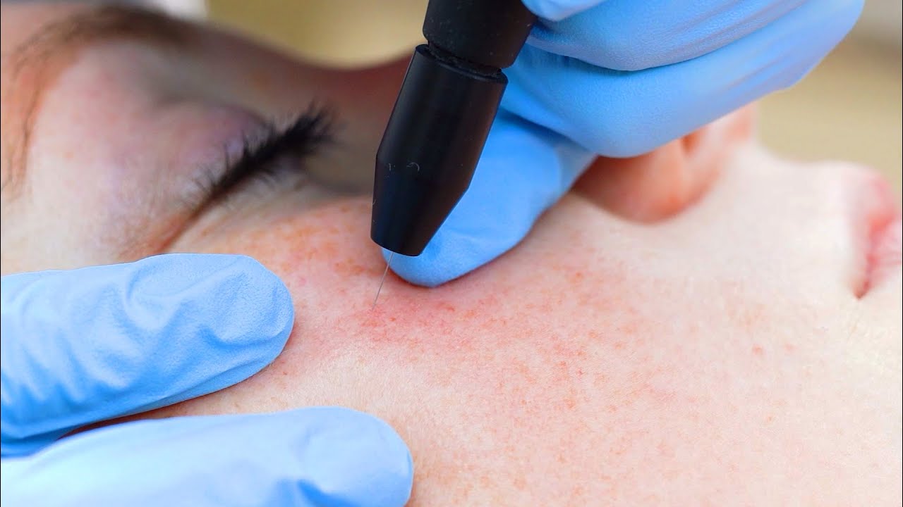 Huidverstoringen (Diathermie) - YouTube