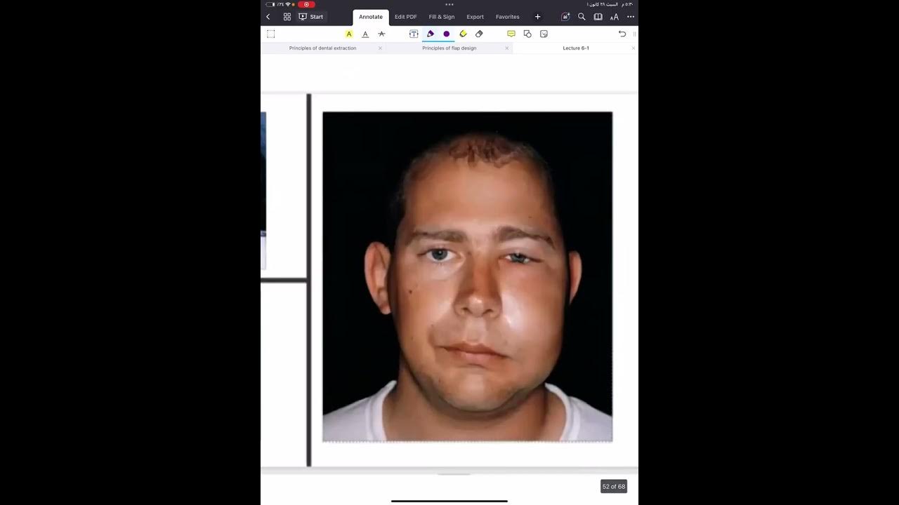 Post operative complications || lecture 6 part 2 - YouTube