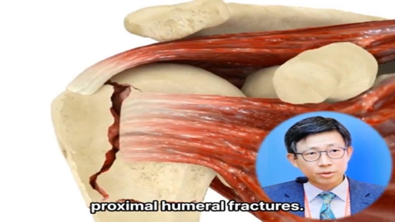 Proximal Humerus 3-Part Fracture: Neer Classification, Causes ...