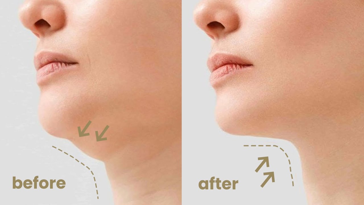 Lipo-dissolve by Dr. Swetha Kurian (Specialist Dermatologist) - YouTube
