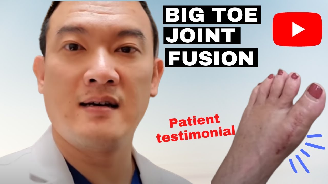 Big Toe Joint Fusion testimonial - YouTube
