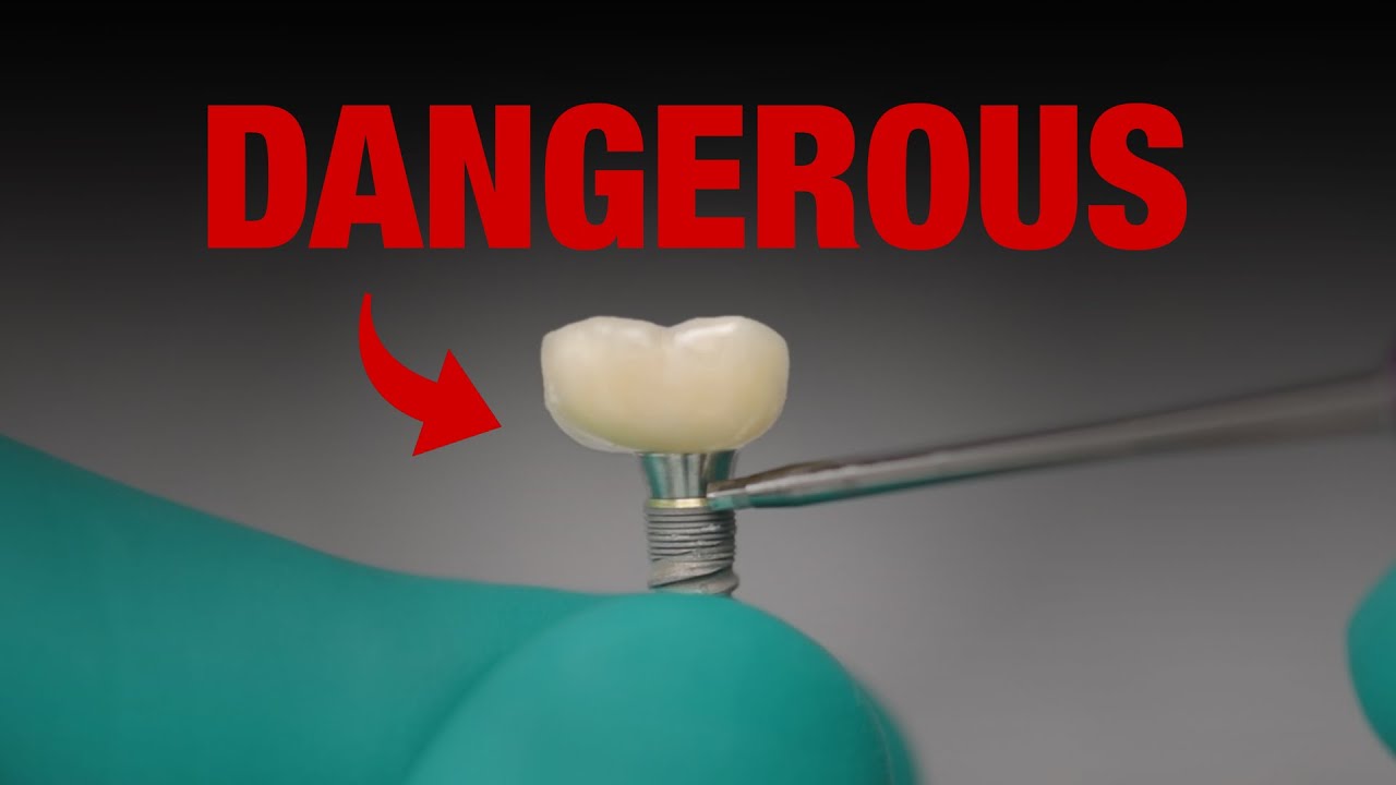 This implant FAILED. Are you making the same mistake? - YouTube