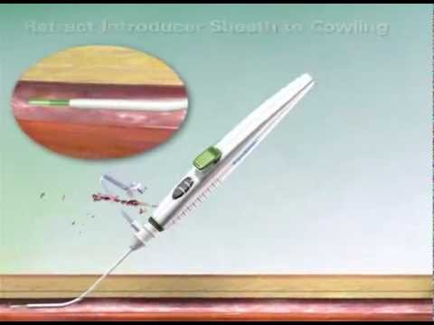 Exoseal Standard In Service - YouTube