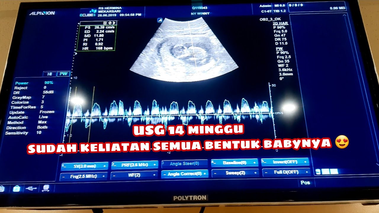 USG janin 14 MINGGU ,udah keliatan semua bentuk bayinya 😍 - YouTube