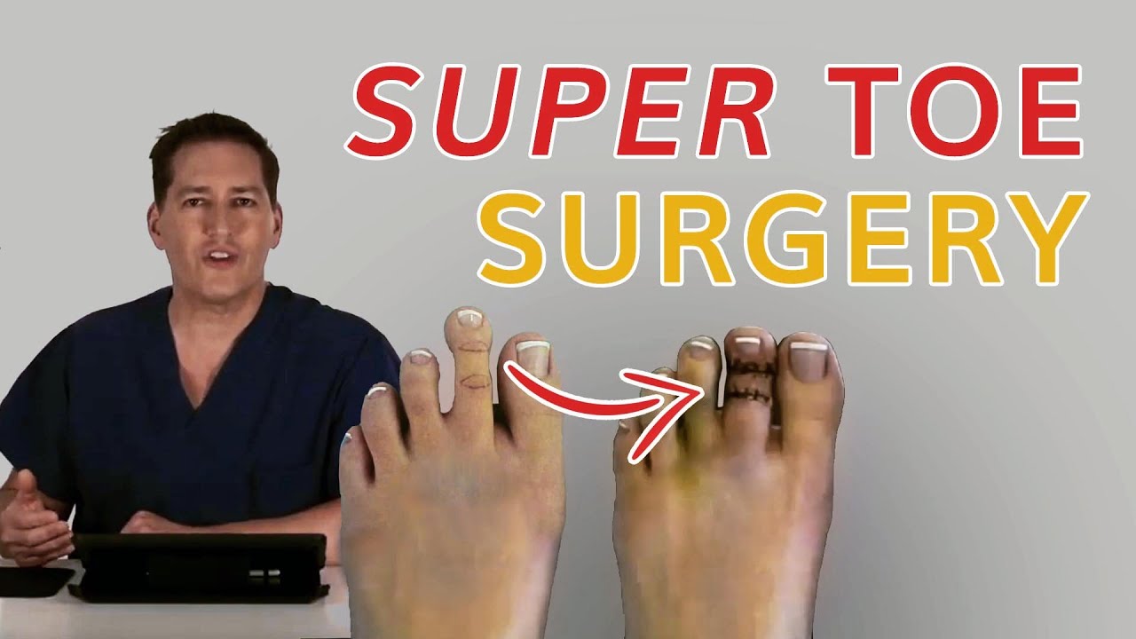 Super Toe Surgery - Dr. Michael Horwitz - Feet For Life Channel - YouTube