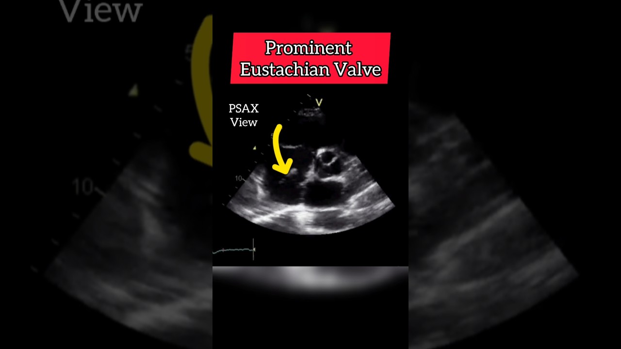 Prominent Eustachian Valve seen in RA on PSAX view #echocardiography ...
