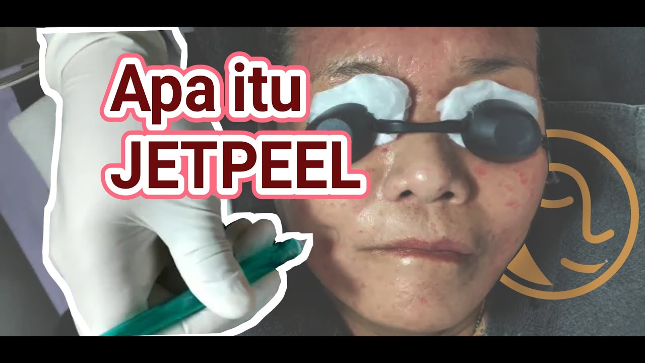 Jet-Peel | Jet-M | Jetpeeling With Oxygen | Natasha Skin Care Treatment ...