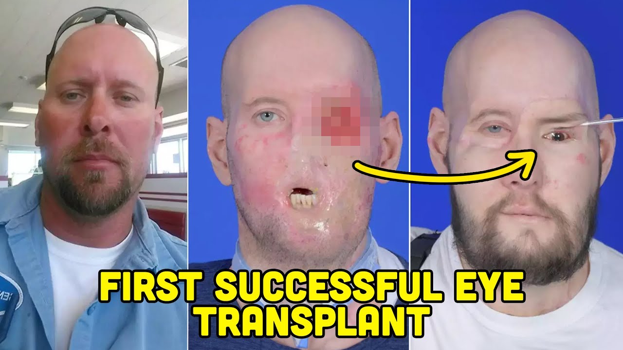 BREAKING: World's First Eye & Partial Face Transplant - YouTube