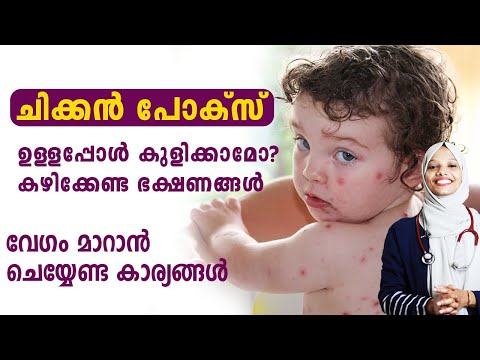 ചിക്കൻ പോക്സ് വേഗം മാറാൻ  |  chickenpox malayalam | Dr couple