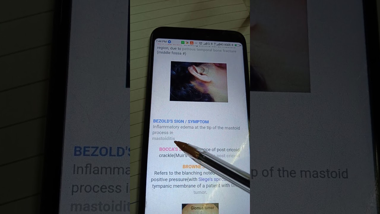 Bezold's sign - YouTube