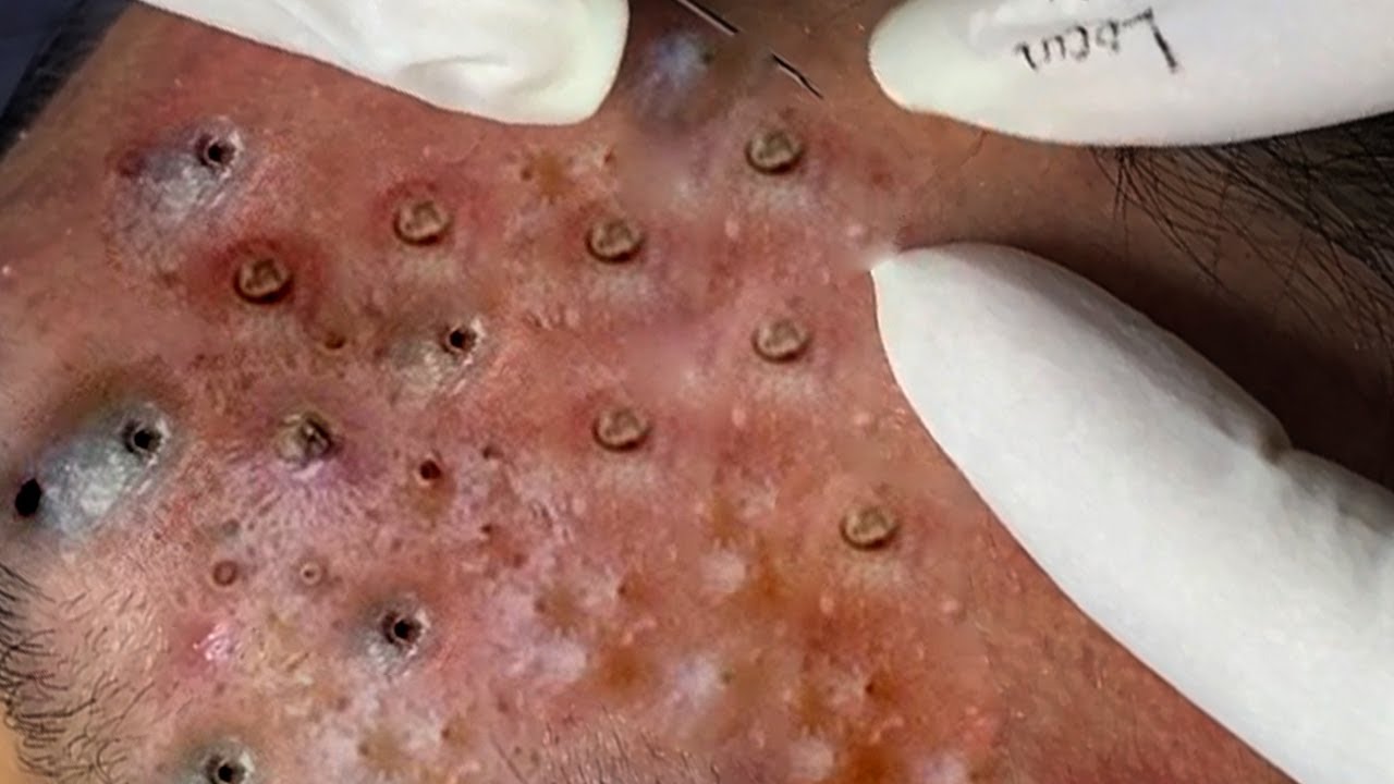 𝐌𝐨𝐬𝐭 𝐒𝐚𝐭𝐢𝐬𝐟𝐲𝐢𝐧𝐠 𝐏𝐢𝐦𝐩𝐥𝐞𝐬 𝐑𝐞𝐦𝐨𝐯𝐚𝐥 𝐀𝐭 𝐇𝐨𝐦𝐞 #1855 - YouTube