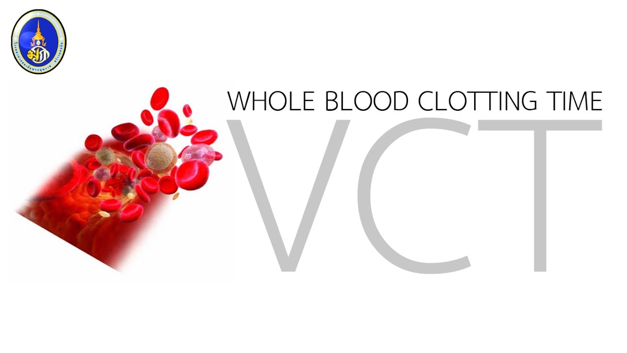 วิธีปฏิบัติการทดสอบ Whole Blood Clotting Time หรือ VCT | กลุ่มงานพยาธิ ...