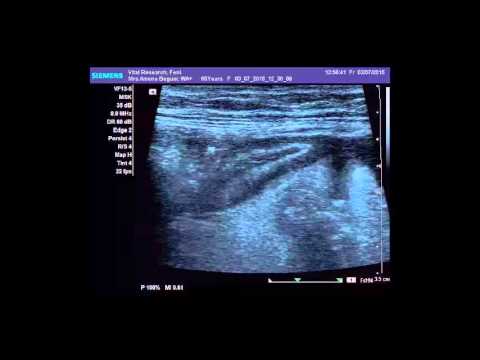 USG OF APPENDIX - YouTube