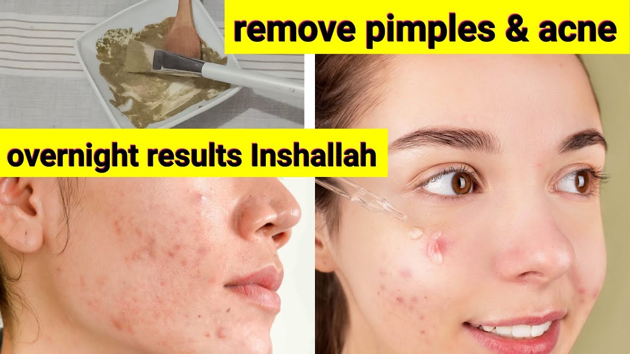 How to remove pimples overnight|acne treatment|home remedy for pimples ...