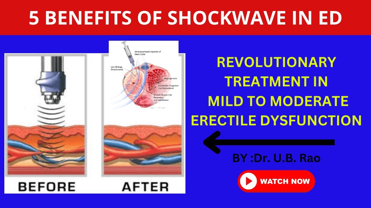 Shockwave treatment for Mild to Moderate Erectile Dysfuction (Most ...