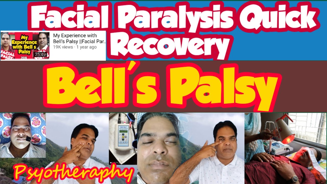 Bell's Palsy Recovery || Facial Paralysis Treatment & Exercises | How ...