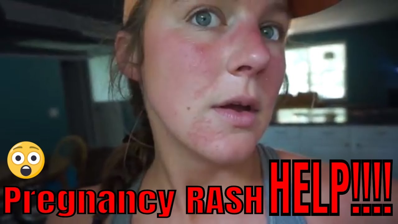 Pregnancy RASH YouTube pregnancy-rash-youtube