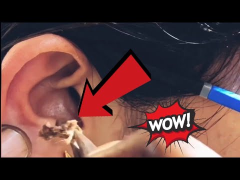 Huge ear wax picked out from both ears - YouTube