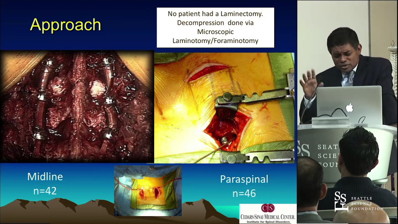 Minimally Invasive Spinal Surgery (MISS) - Neel Anand, MD - YouTube