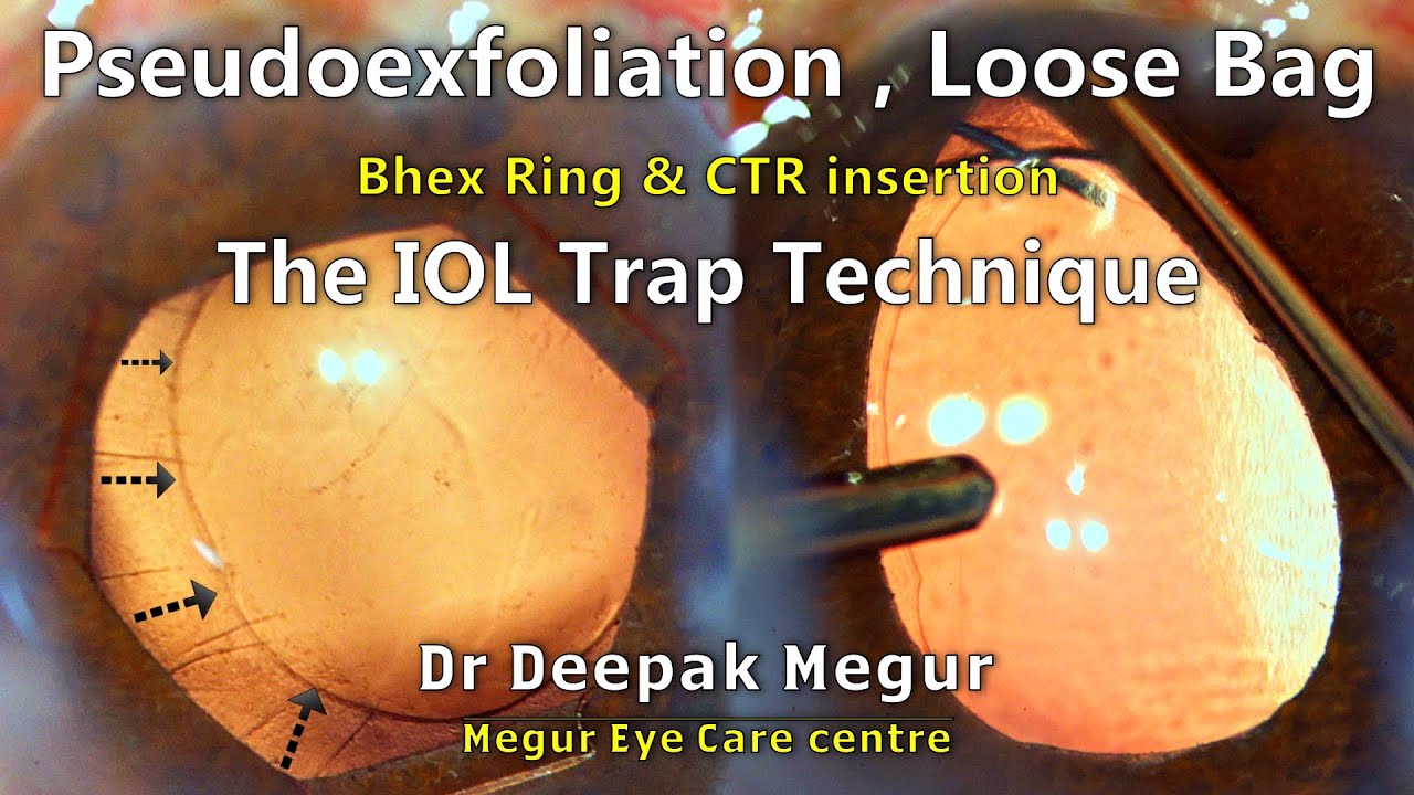Pseudoexfoliation , Loose bag & Bhex ring , IOL Trap Technique - Dr ...