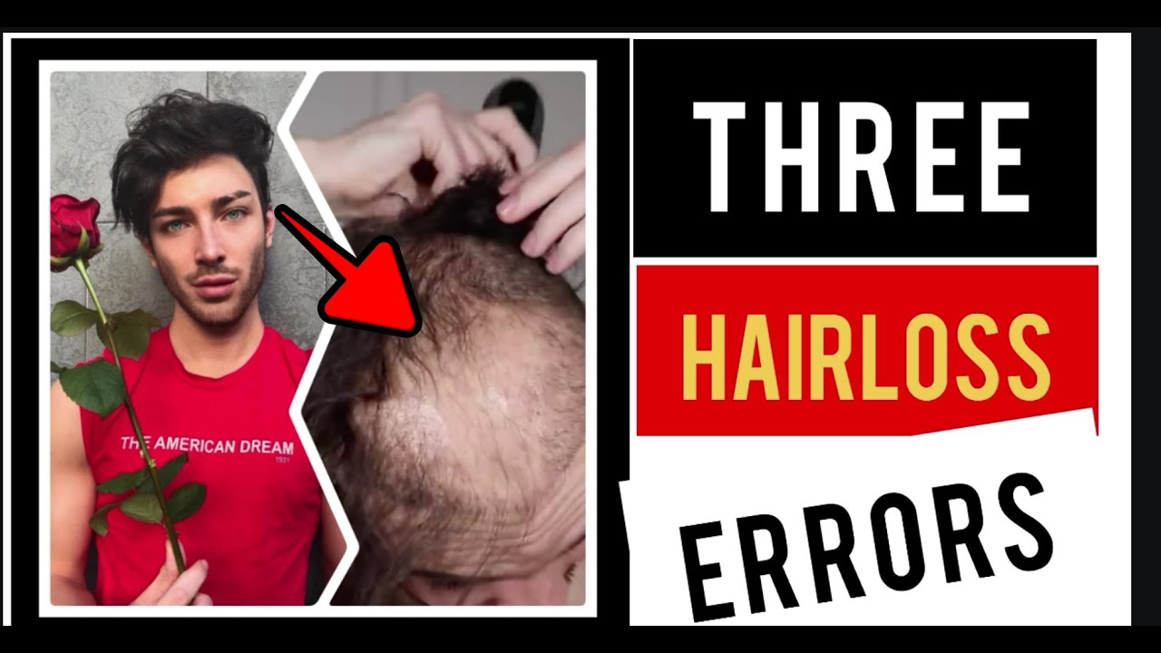 MODEL HAS A FUE HAIR TRANSPLANT DISASTER - Avoid The Three Errors Made ...