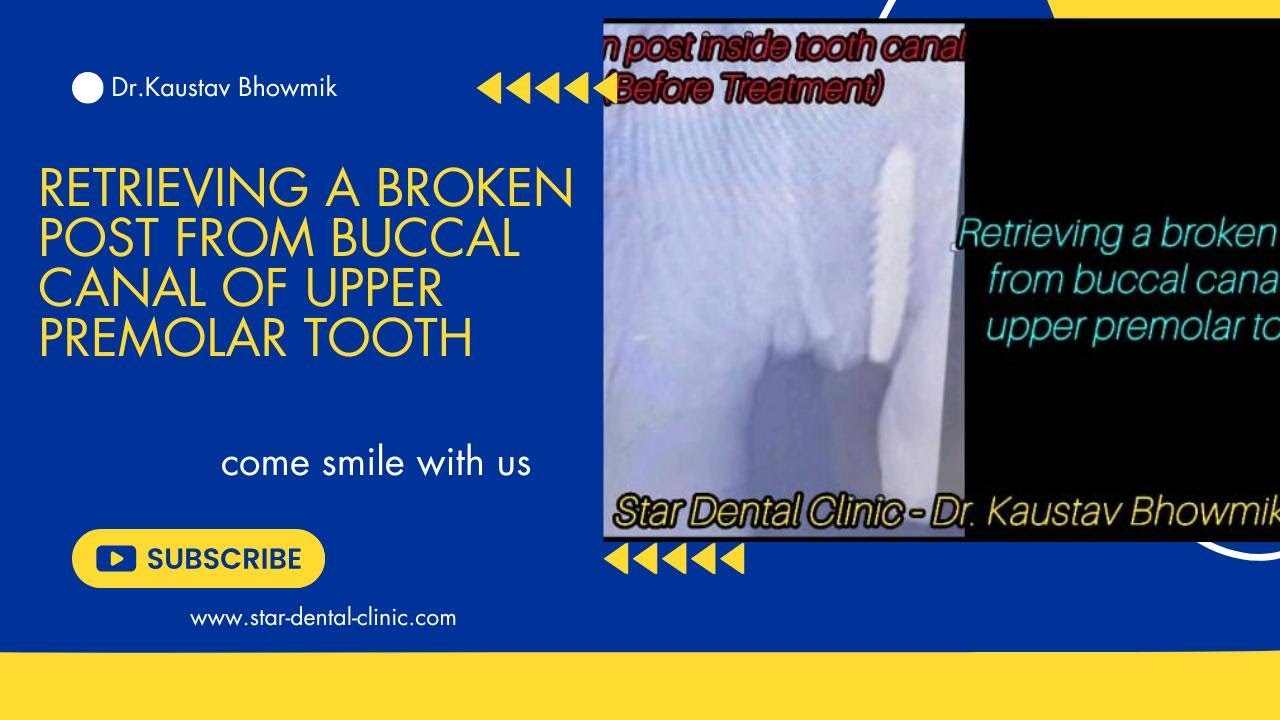 Retrieving a broken post from buccal canal of upper premolar tooth ...