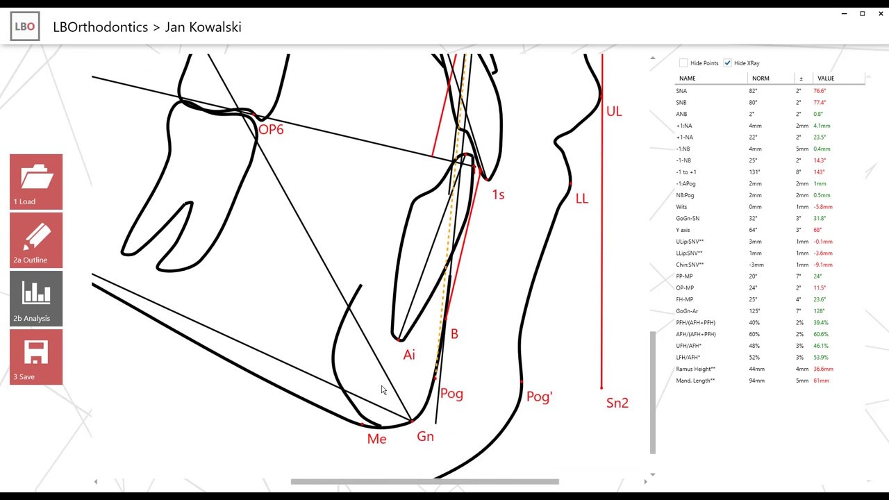 Cephalometric Analysis LBOrthodontics - YouTube