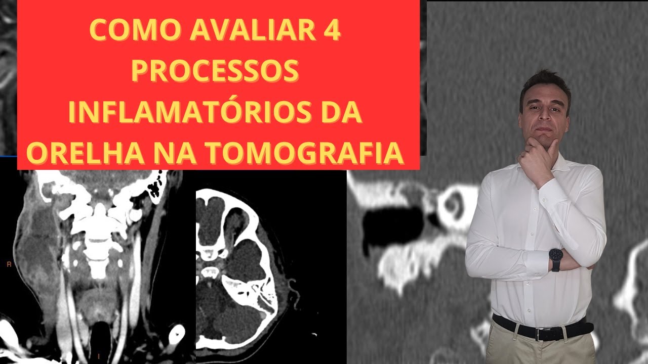 Como avaliar otite "dor de ouvido" média aguda e crônica, colesteatoma ...