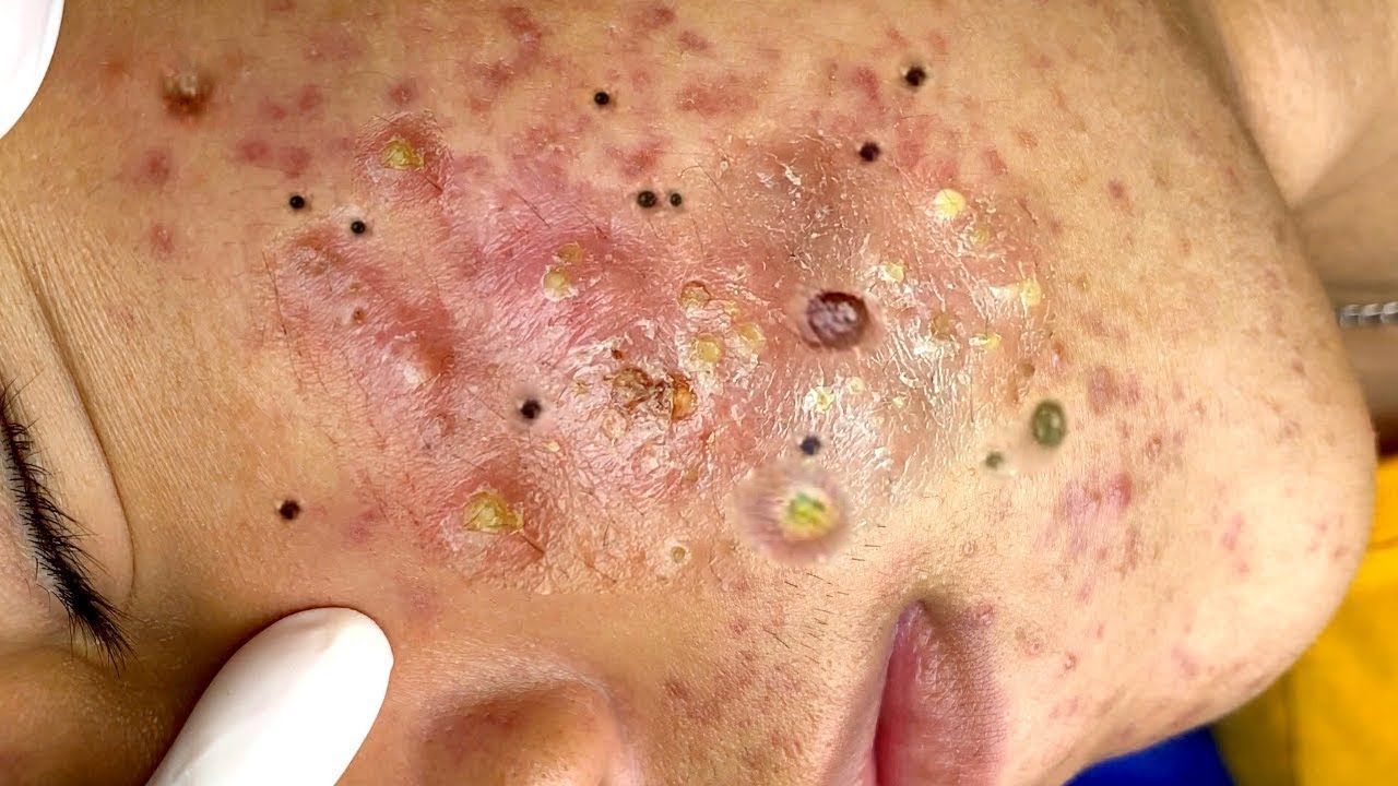 Big Cystic Acne Blackheads Extraction Blackheads & Milia, Whiteheads ...