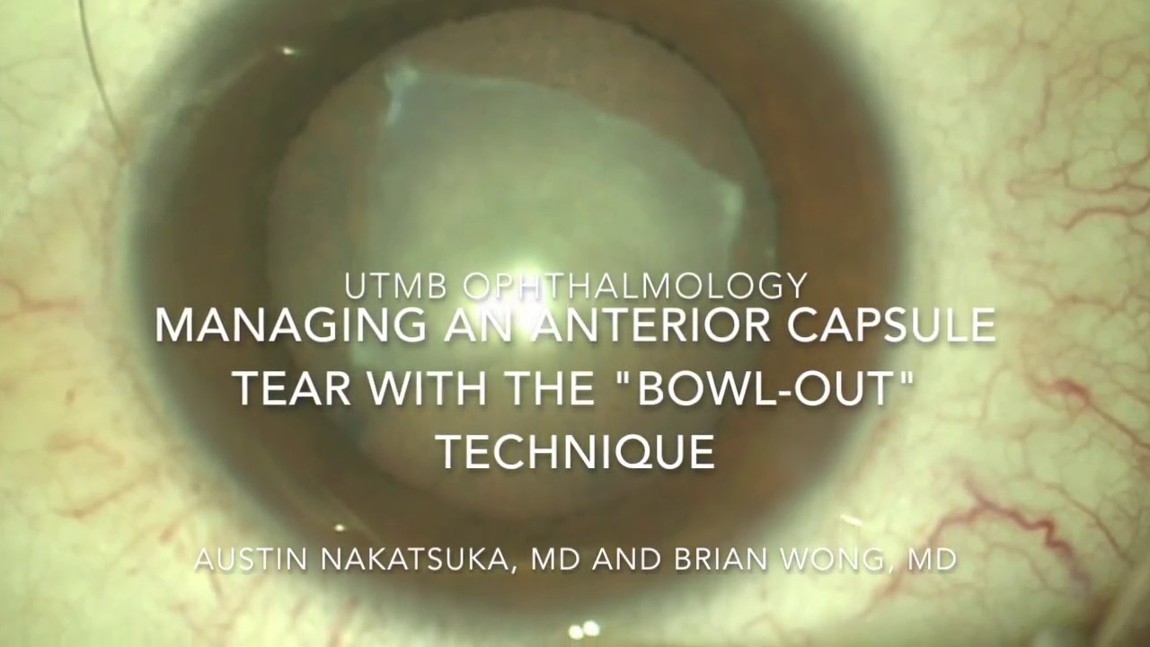 Managing Anterior Capsule Tear with the Bowl Out Technique - YouTube