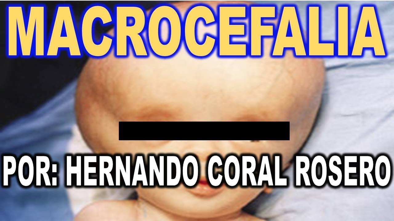 MACROCEFALIA (CRECIMIENTO EXCESIVO DEL CEREBRO) - YouTube