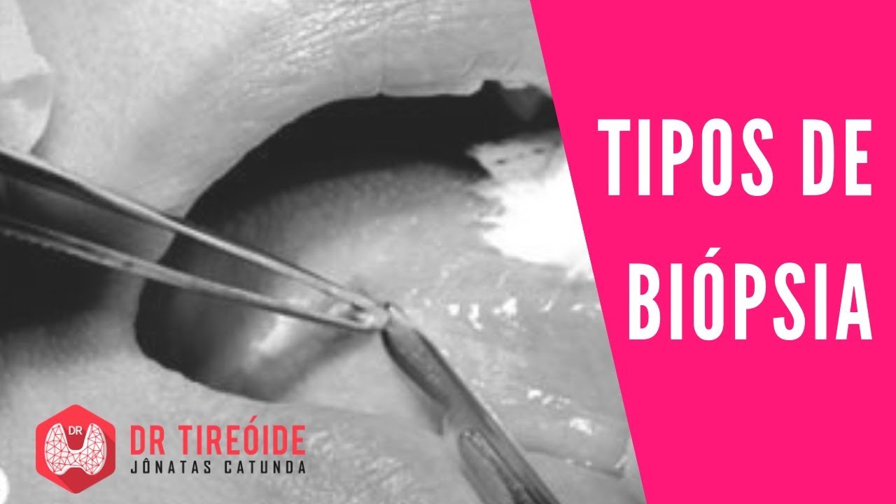 Biópsia Incisional Ou Excisional - RETOEDU