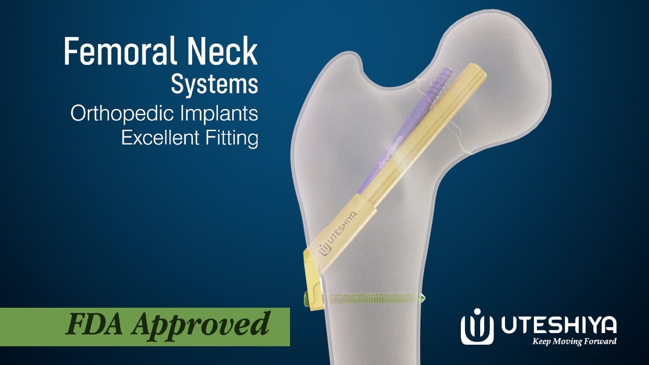 Uteshiya Medicare Femoral Neck System - YouTube