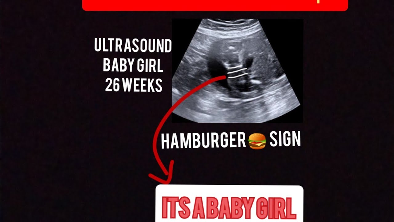 Hamburger Sign Ultrasound