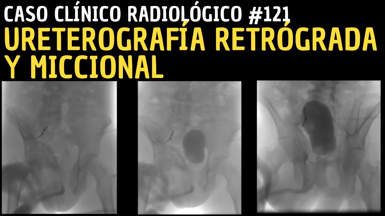 Caso clínico 121: Ureterografía retrógrada y miccional. - YouTube